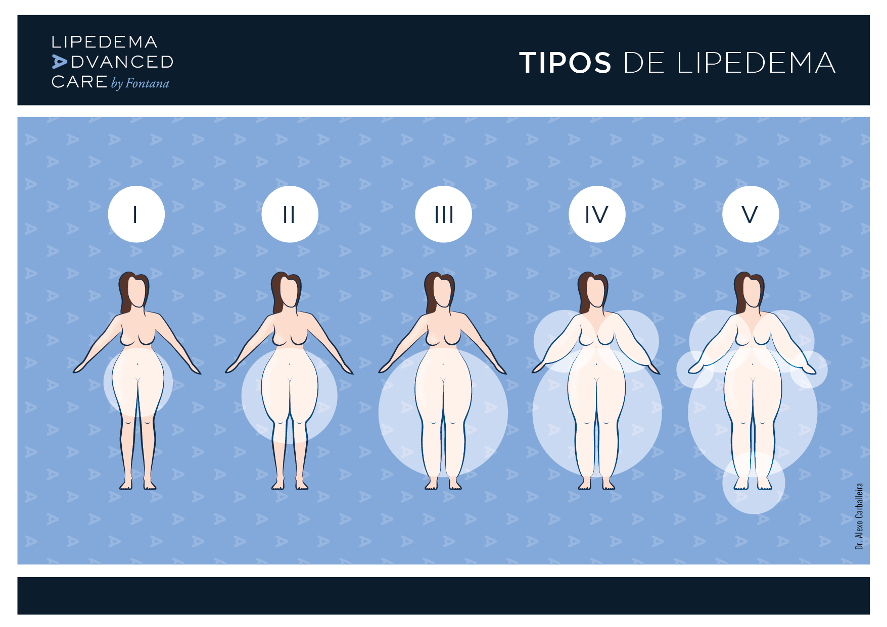 Grades And Types Of Lipedema: Complete Classification And ...